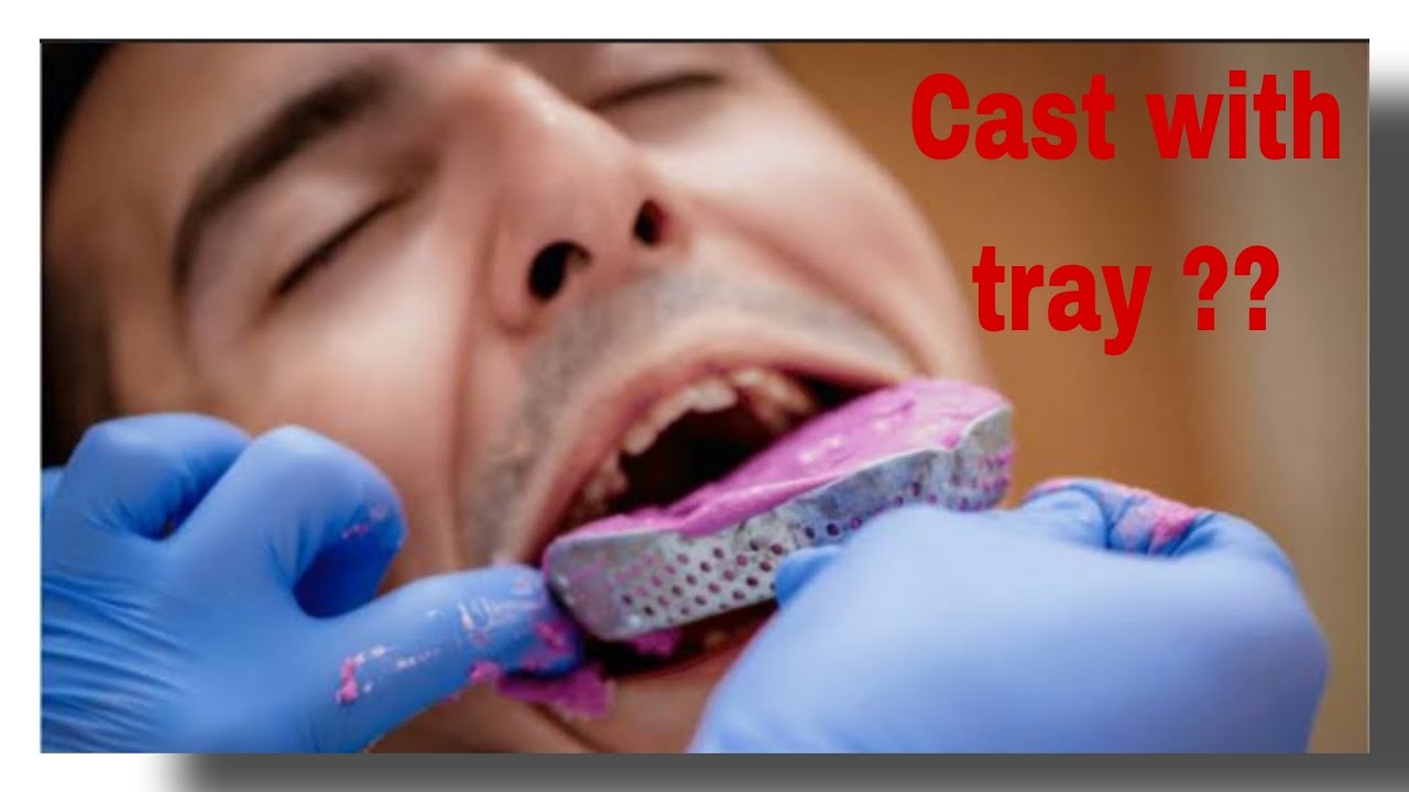 How to make cast for edentulous patients by tray ??? #NMU - YouTube