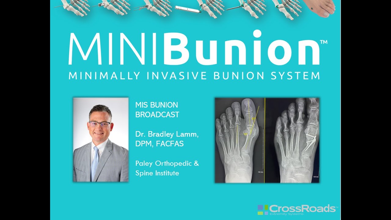 MINIBunion: MIS Bunion System - Webinar with Dr. Bradley Lamm - YouTube