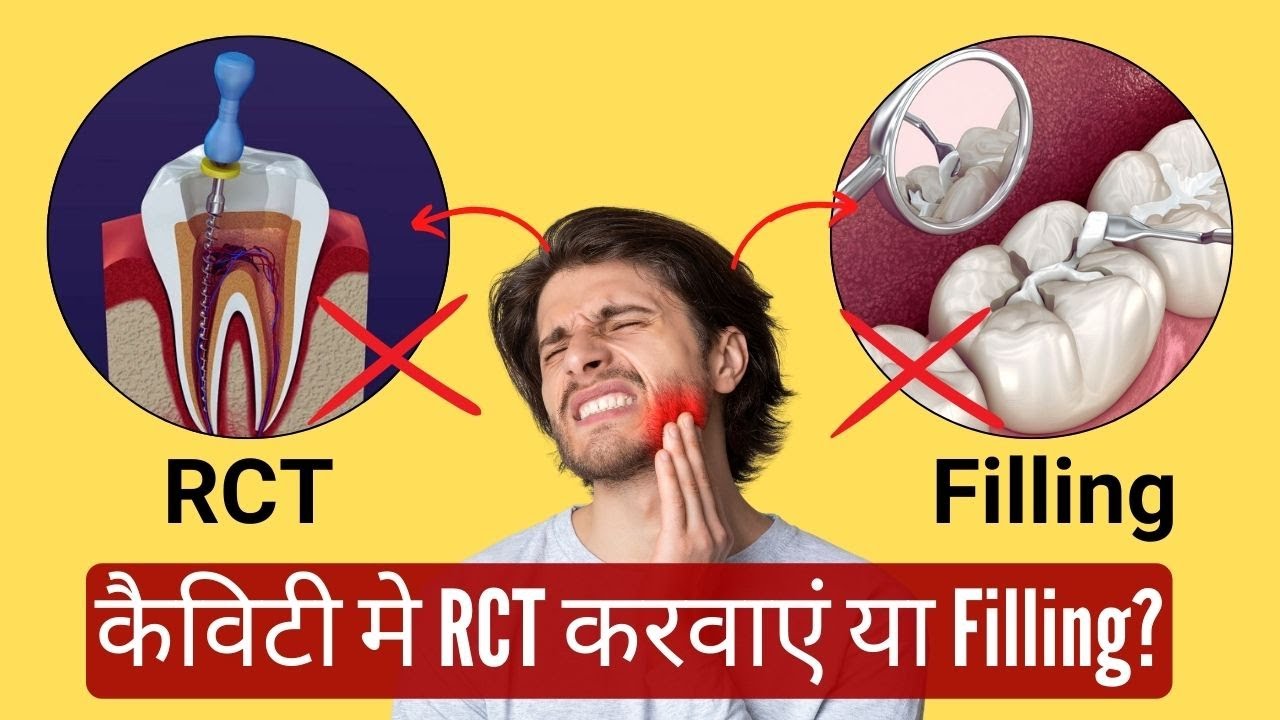 कैविटी मे RCT करवाएं या Filling? | RCT vs. Filling: How to Decide ...