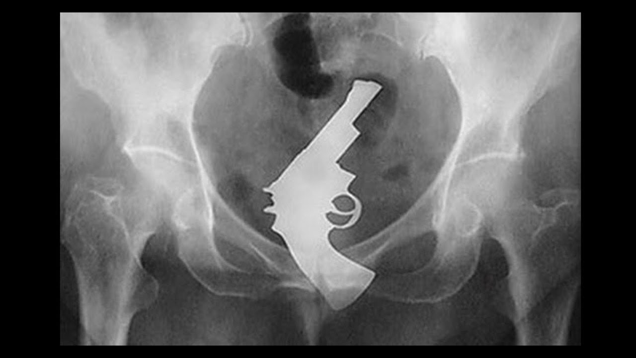 You Won't Believe The Wide Array Of Things That People Got Stuck Inside ...