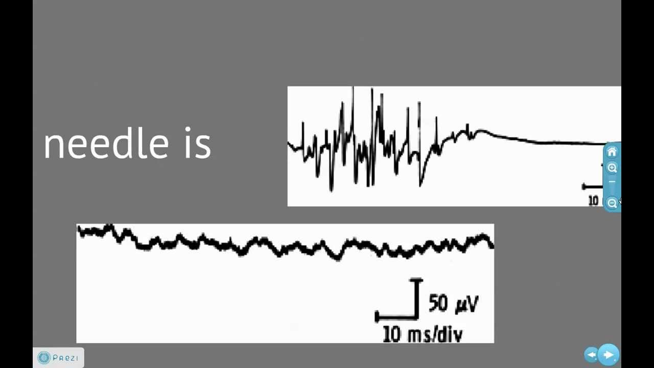 EMG and Action Potentials - YouTube