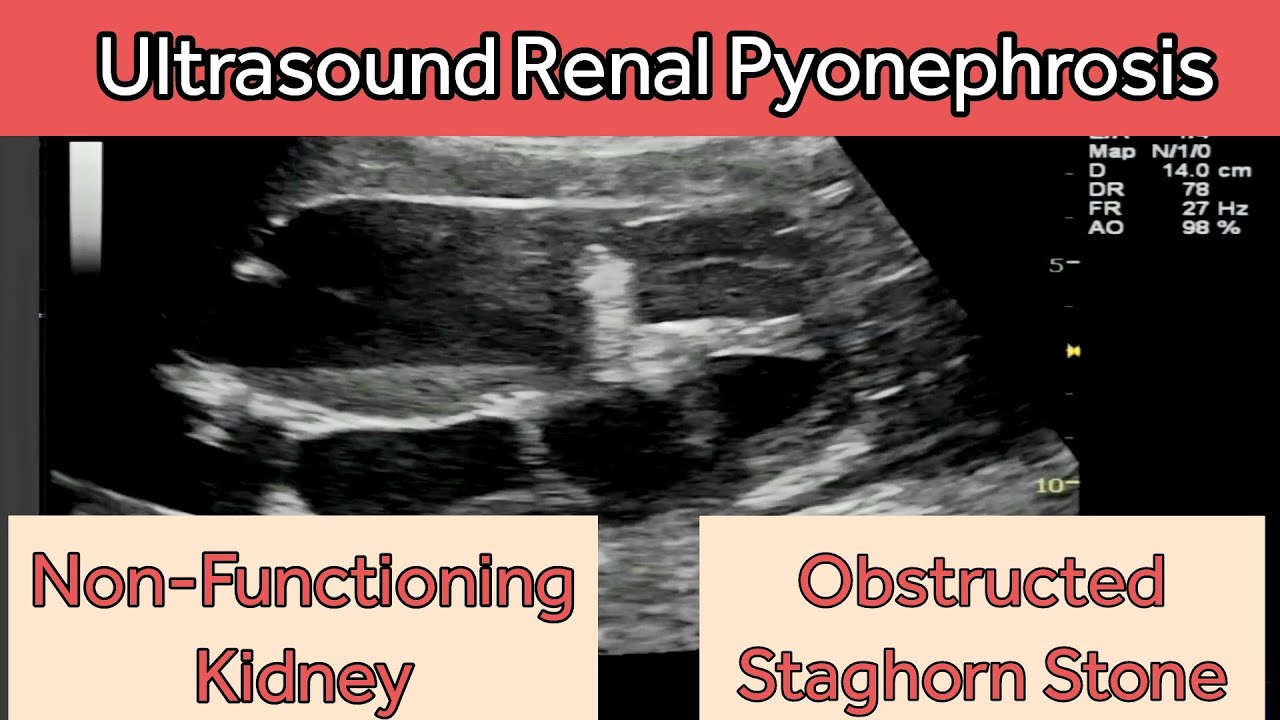 Renal Pyonephrosis | Non-Functioning Kidney | Staghorn Calculus ...