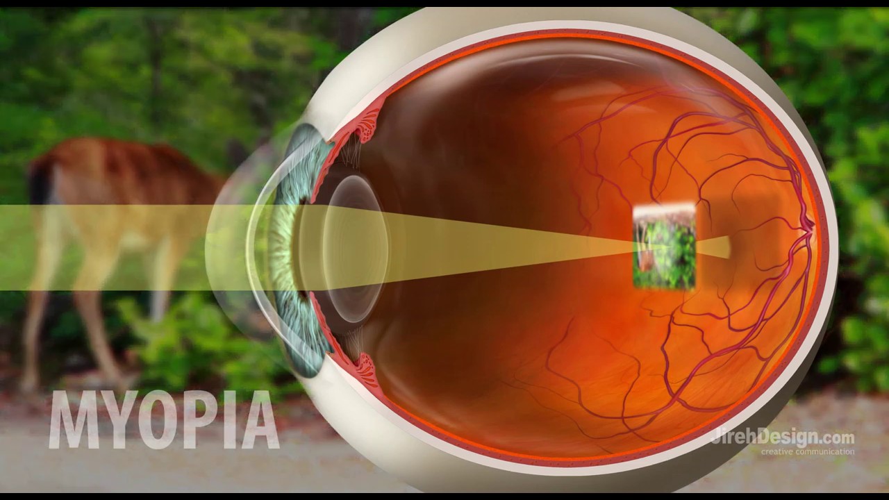 Myopia | Nearsightedness explained [HD] - YouTube