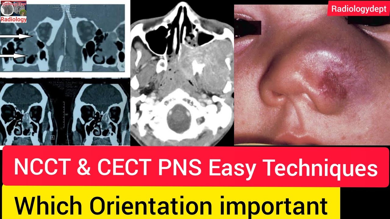 CT PNS & CECT PNS Easy Techniques In Hindi || CT PnS Techniques ...