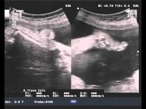 Aloka - Neu Laxova Syndrome - YouTube