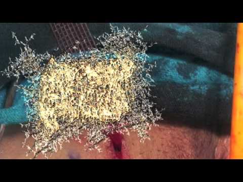 Larvae-Affected Cerebral Liquidization - Surgical Repair Of Uterine ...