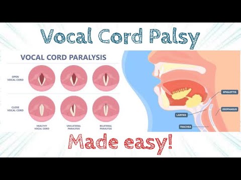 Vocal Cord Palsy ENT/Anatomy (English) - YouTube