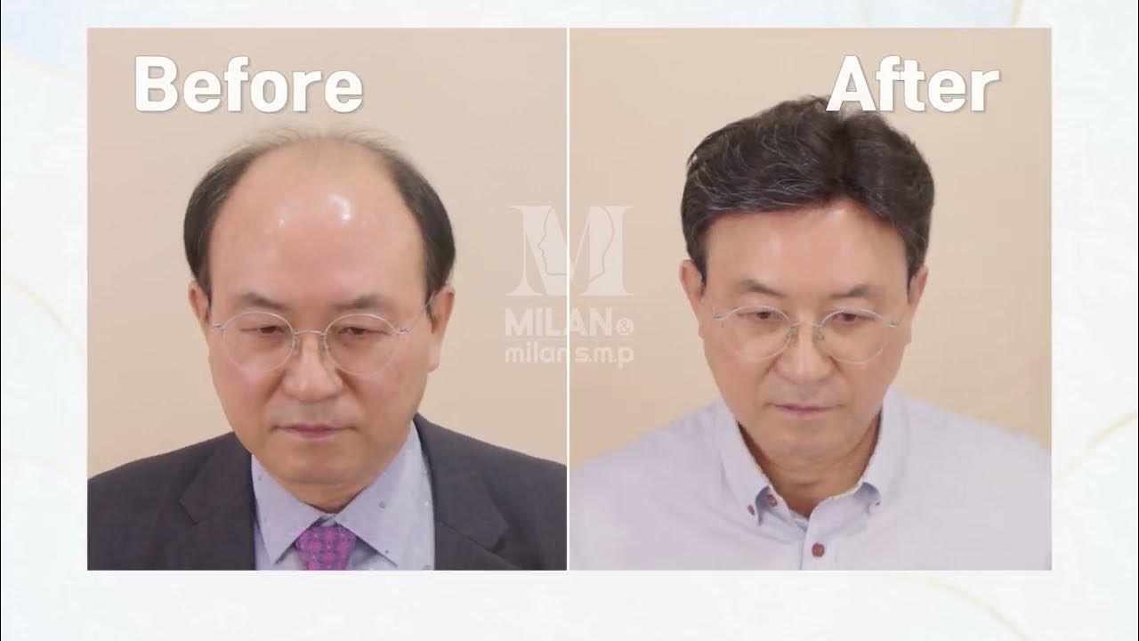 남자 가발 여자 가발 And 숱채움 역시 밀란 가발 퀄리티 차이 Just See Youtube