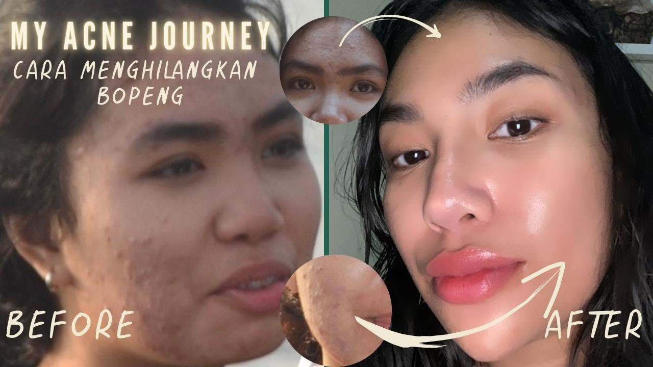 My Journey Acne & Cara Menghilangkan Bopeng - YouTube