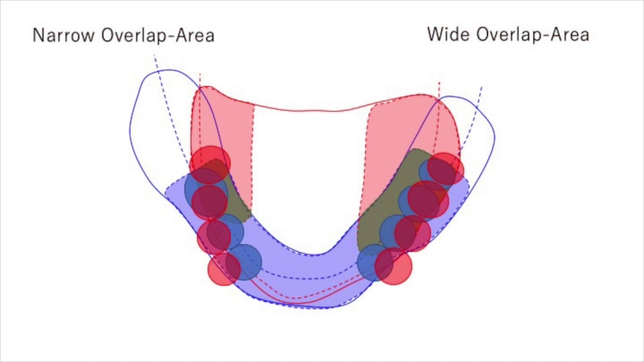 Setting up teeth for cross bite - YouTube