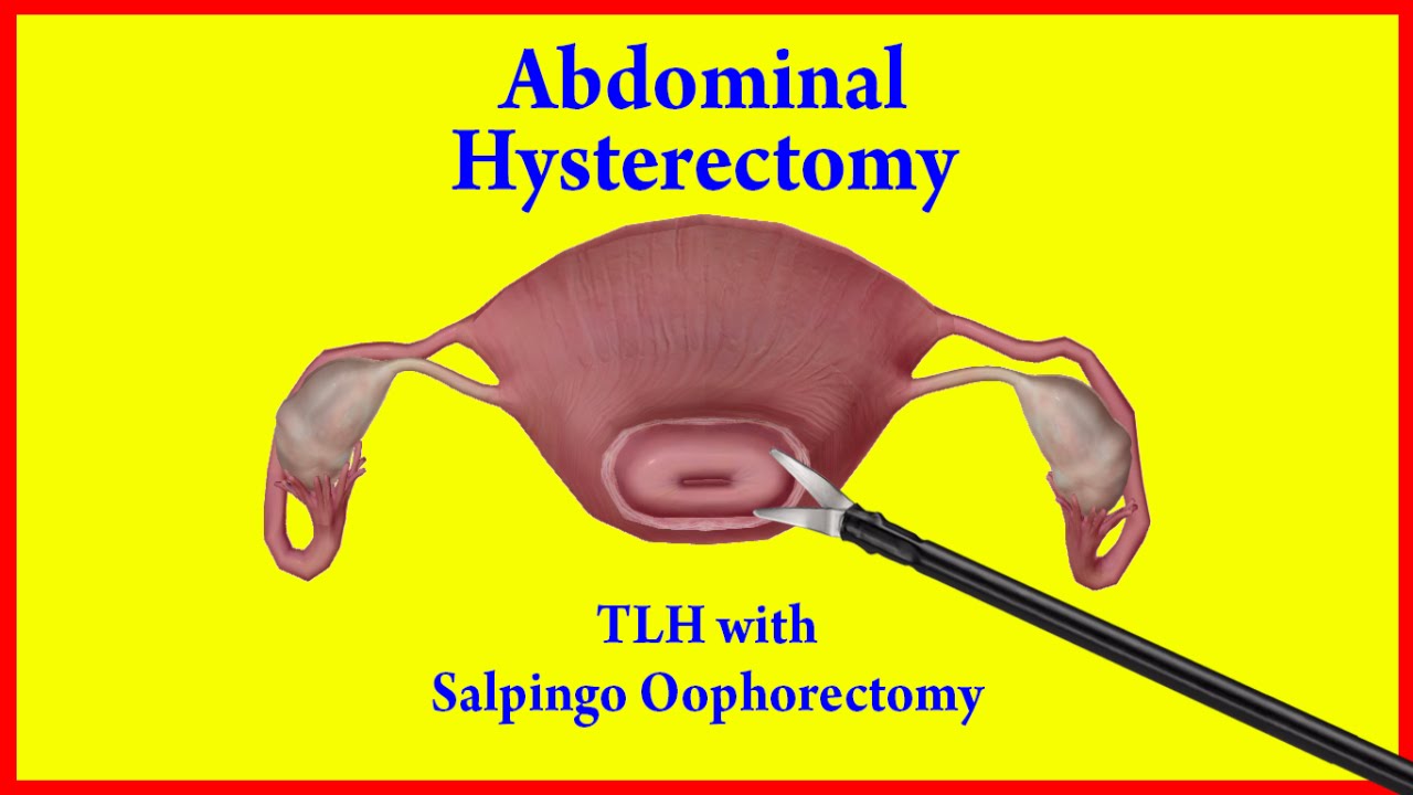 TLH How To Do Total Abdominal Hysterectomy With Salpingo Oophorectomy