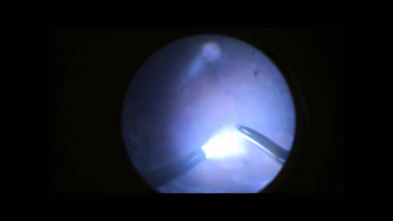 Retinal break during ROP surgery. Prematurity retinopathy surgery - YouTube