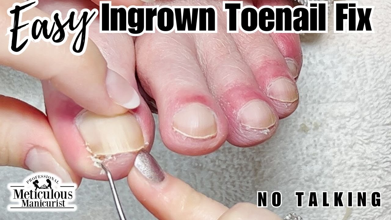 Ingrown Toenail at Home Pedicure for Beginners - YouTube
