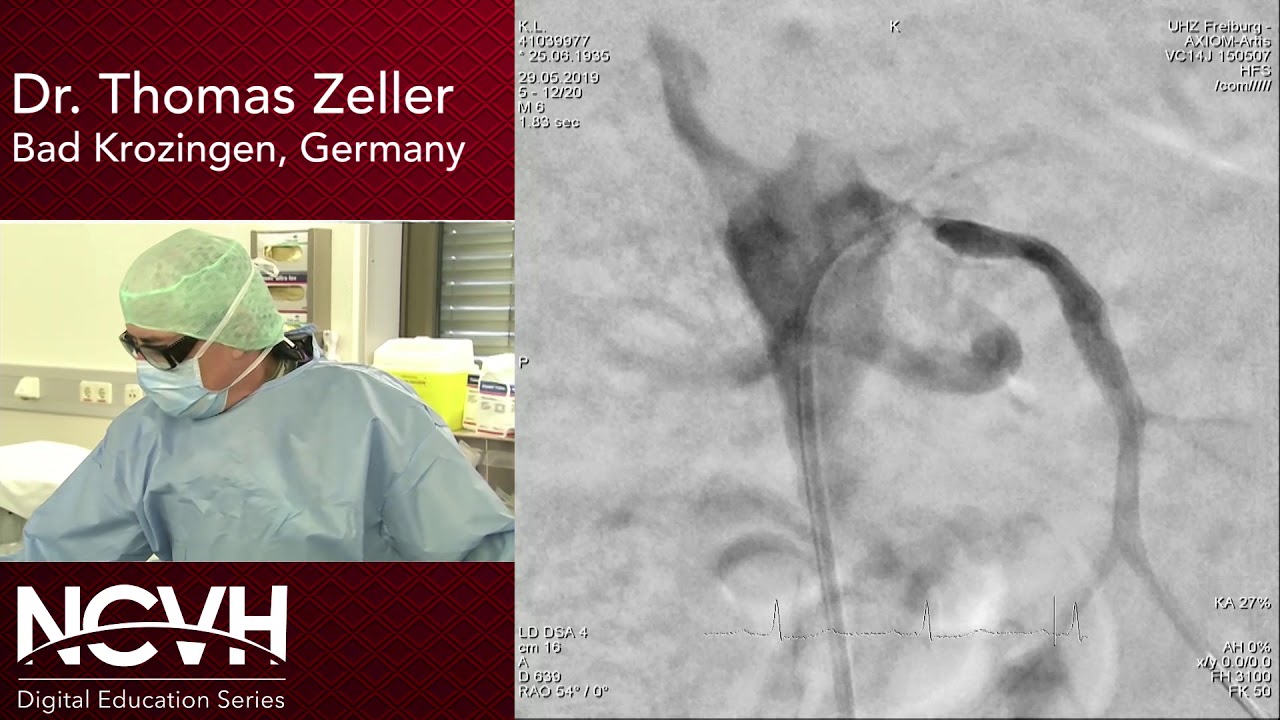 Professor Thomas Zeller, Live Case: Stenting of Ostial Stenosis of the ...