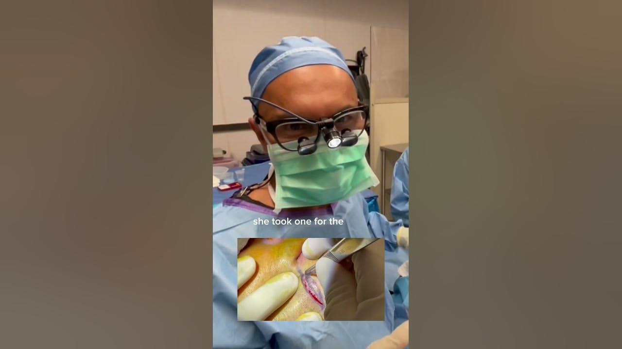 Removal Of Huge Cyst From Chin Dr Tanveer Janjua New Jersey Youtube
