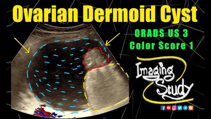 Dermoid Ovarian Cyst Ultrasound