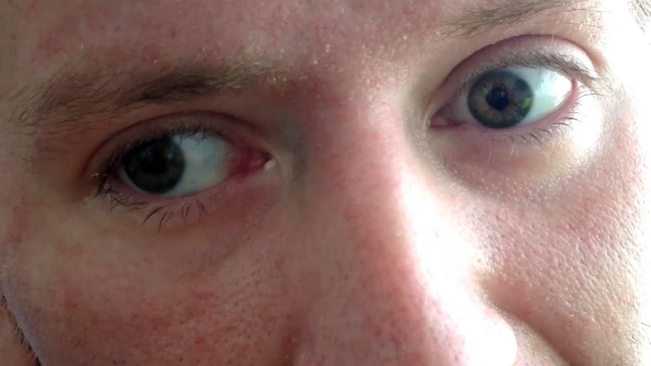 2014-04-16 Nistagmo: movimiento involuntario e incontrolable de los ...