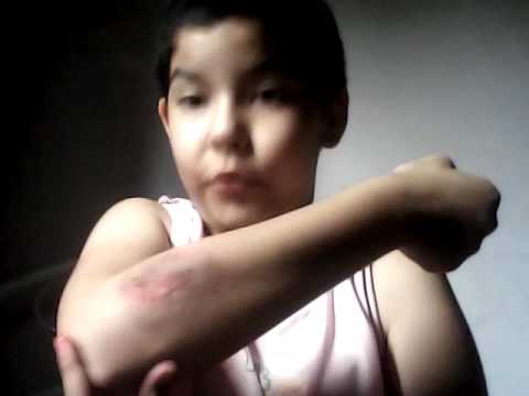 Como hacer un moretón sin que te duela - YouTube