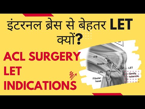 ACL के लिए इंटरनल ब्रेस से बेहतर LET क्यों? Indications of LET in ACL ...