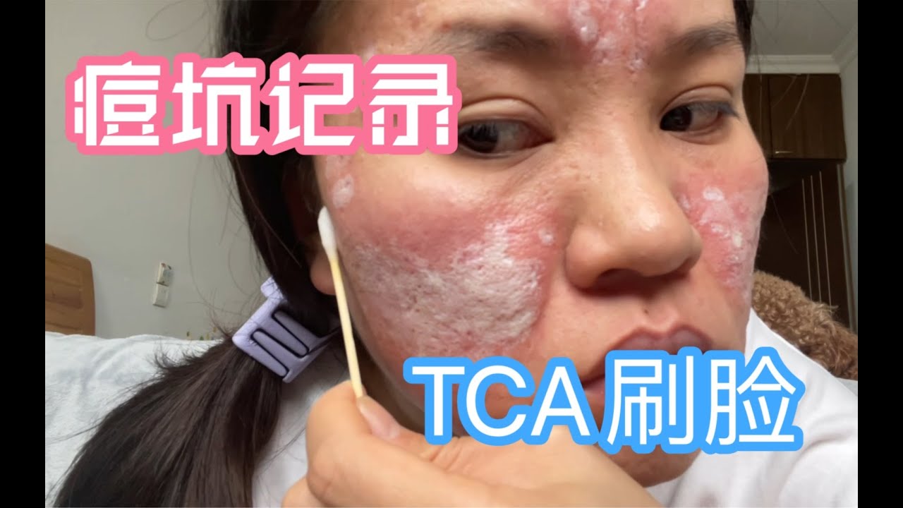 今年的第一次Tca刷脸记录，上海隔离两个多月胖了好几斤，期待赶紧解封，我要去做填充 - YouTube