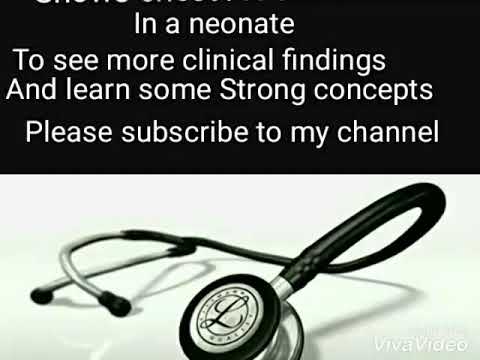 Sternal chest retractions : a must watch clinical finding - YouTube