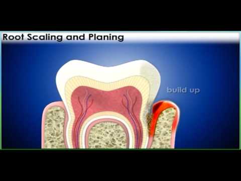 100% cure - BLEEDING GUMS ( GINGIVITIS, PYORRHEA,PYRIA ) by Scaling ...