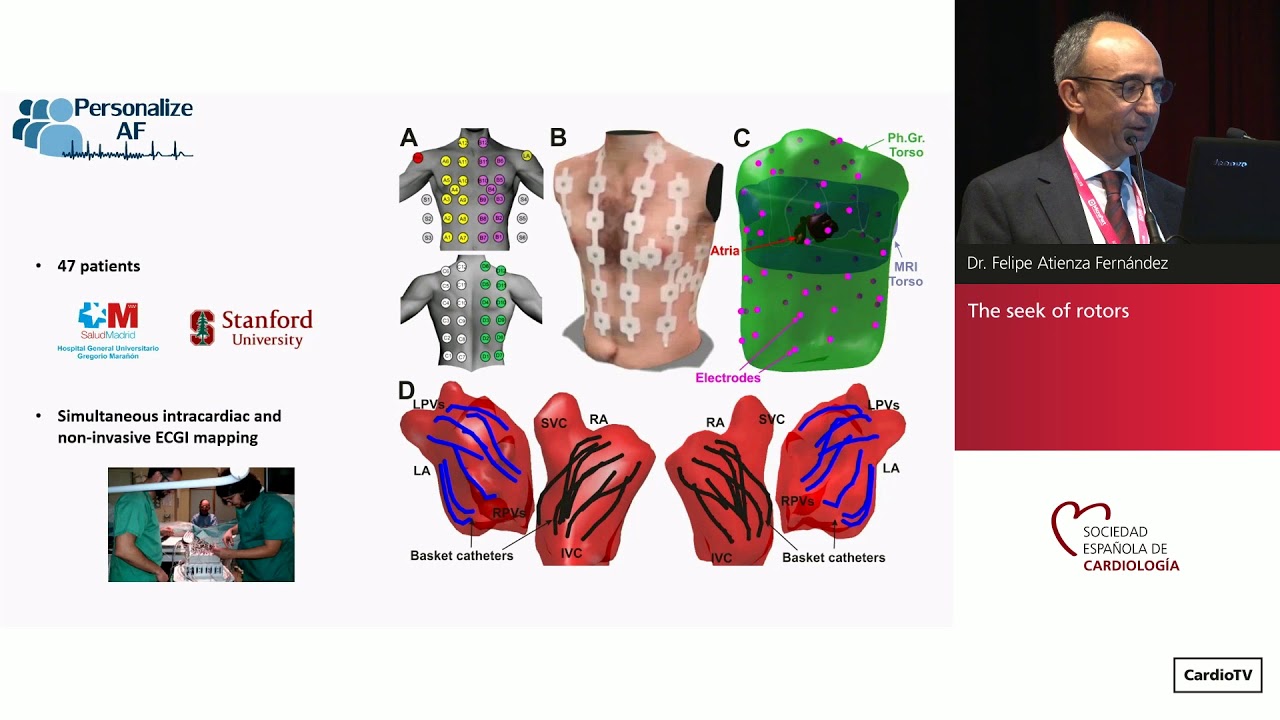 Persistent atrial fibrillation. Can we improve our results? (Joint ...