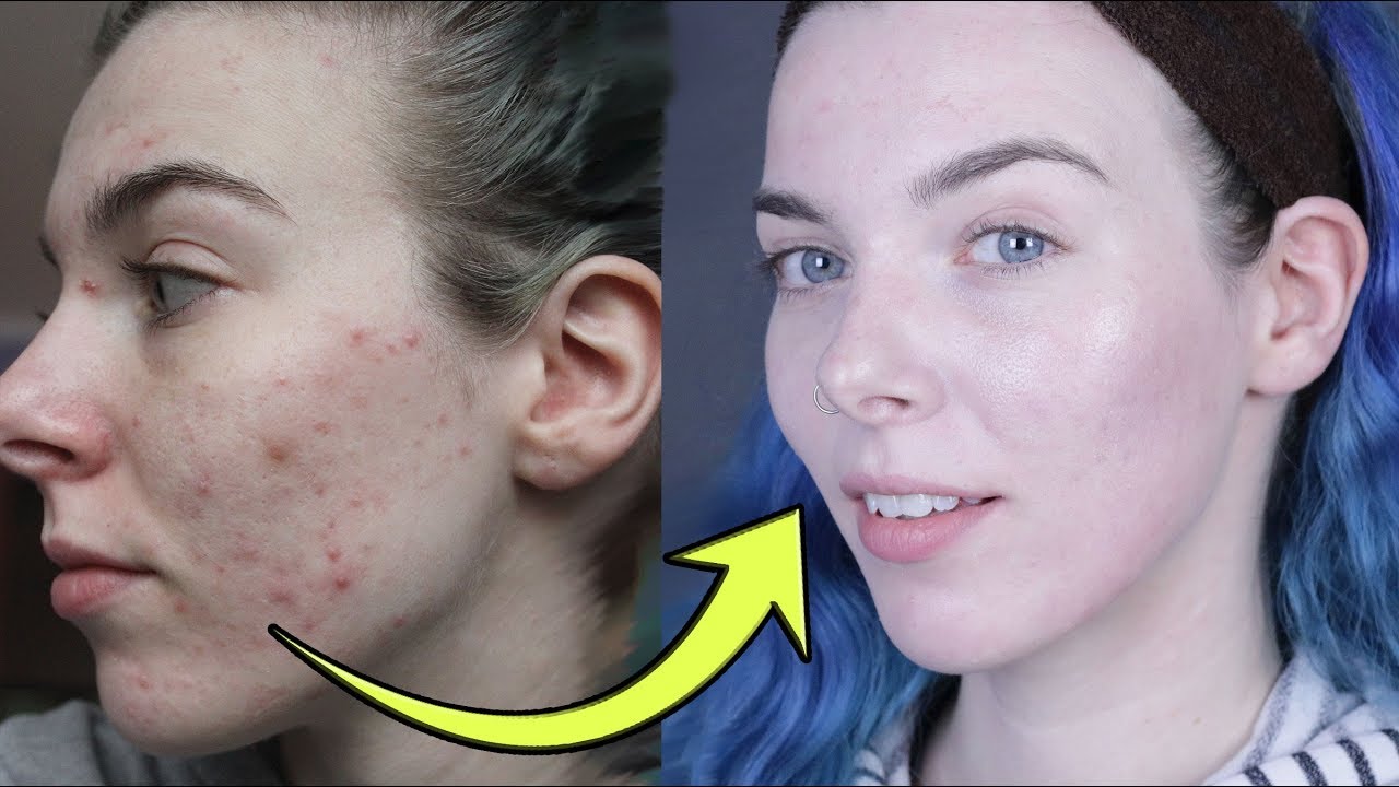 AKNE KOMPLETT WEG? - #AntiZuckerChallenge - Fazit nach 6 Monaten - YouTube
