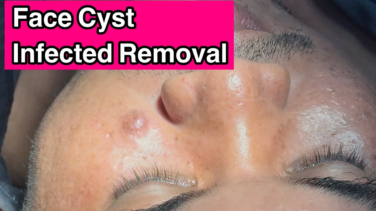 Face Cyst Infected Removal - YouTube
