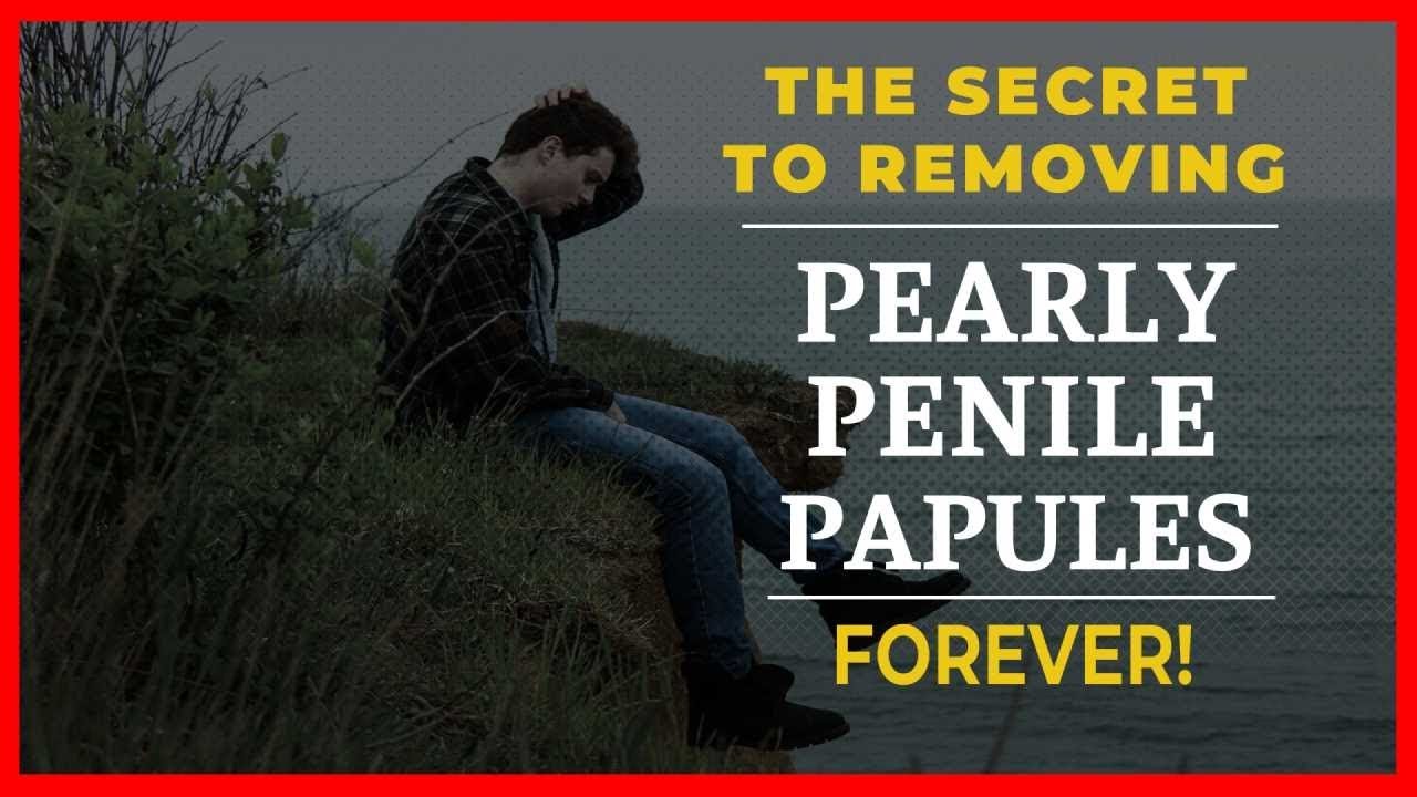 How To Get Rid Of Pearly Penile Papules Without Surgery | Some Serious ...