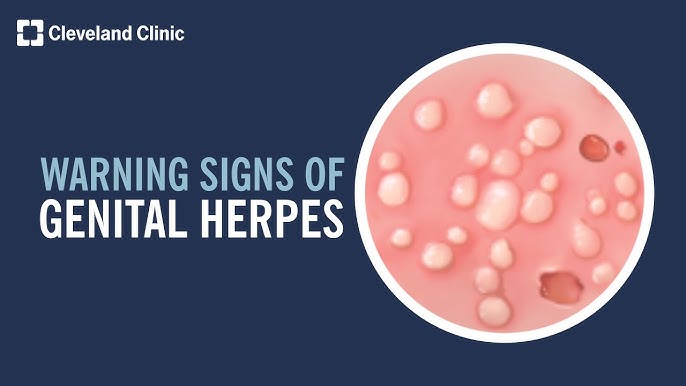 Herpes Std Symptoms