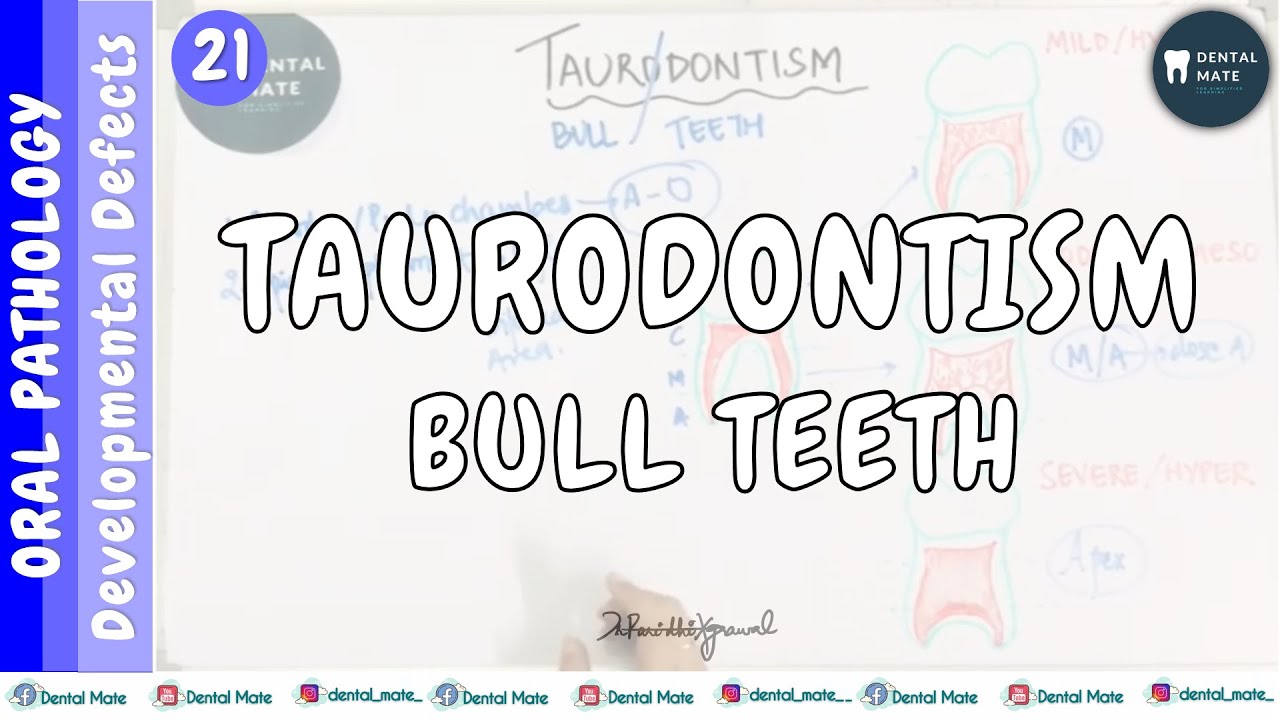 Taurodontism | Bull-teeth | Types | Dev disturbance in shape of teeth ...