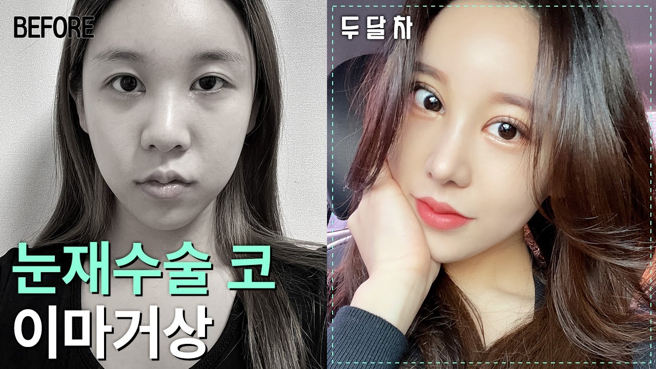 성형브이로그 쌍꺼풀은 여기서 끝낸다👀👉3번째 눈수술과 코성형 이마거상👈으로 레전드 후기 가보자구💘 혜인이 1탄 성형후기