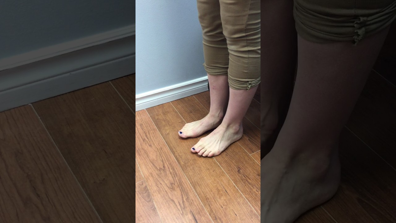 Pedo SG2 Chart 5 Heel Walk Test Heel Spur Syndrome - YouTube