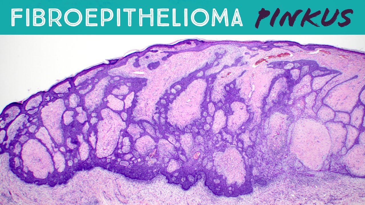 Fibroepithelioma Of Pinkus