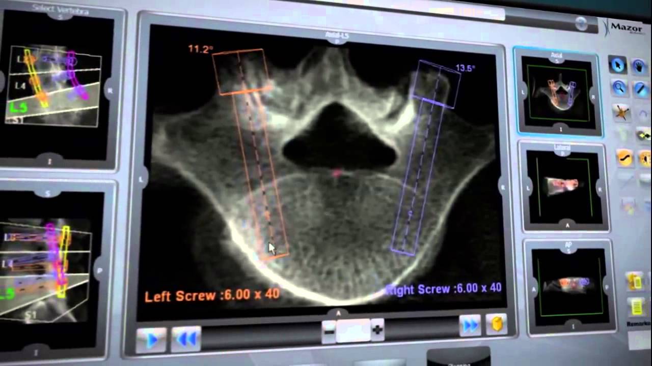 Mazor Robotics Step 1 - Plan - YouTube