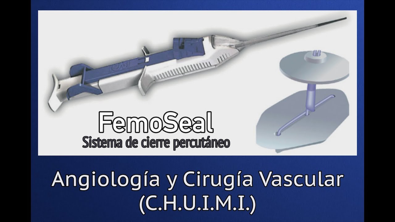 FEMOSEAL: cierre percutáneo - paso a paso - YouTube