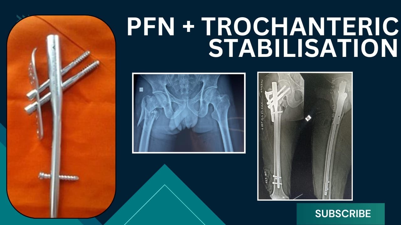 PFN WITH TROCHANTER STABILISATION PLATE IN 27/M WITH COMMUNITED HIP ...