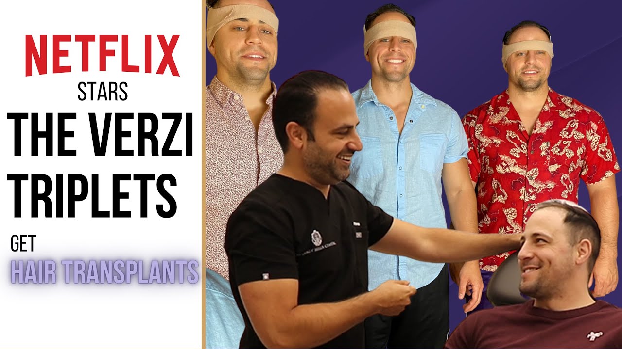 Netflix Stars The Virzi Triplets Get Hair Transplants | Beverly Hills ...