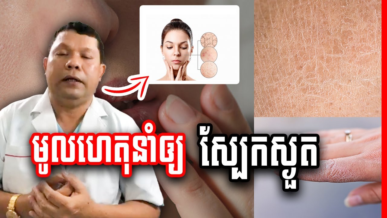 ស្បែកស្ងួតនិងបញ្ហារបស់វា វេជ្ជ. ហែន ភារៈ , Dry Skin and it's problem ...