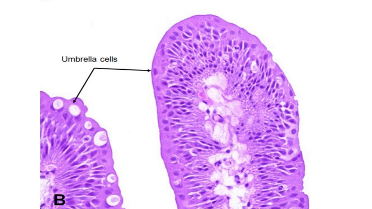 Inflammation and tumours of Ureter and Urinary Bladder - YouTube