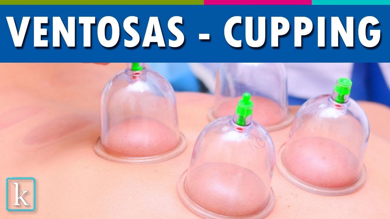 Tratamiento con ventosas - Cupping - Kinesiomed Consultorios - YouTube