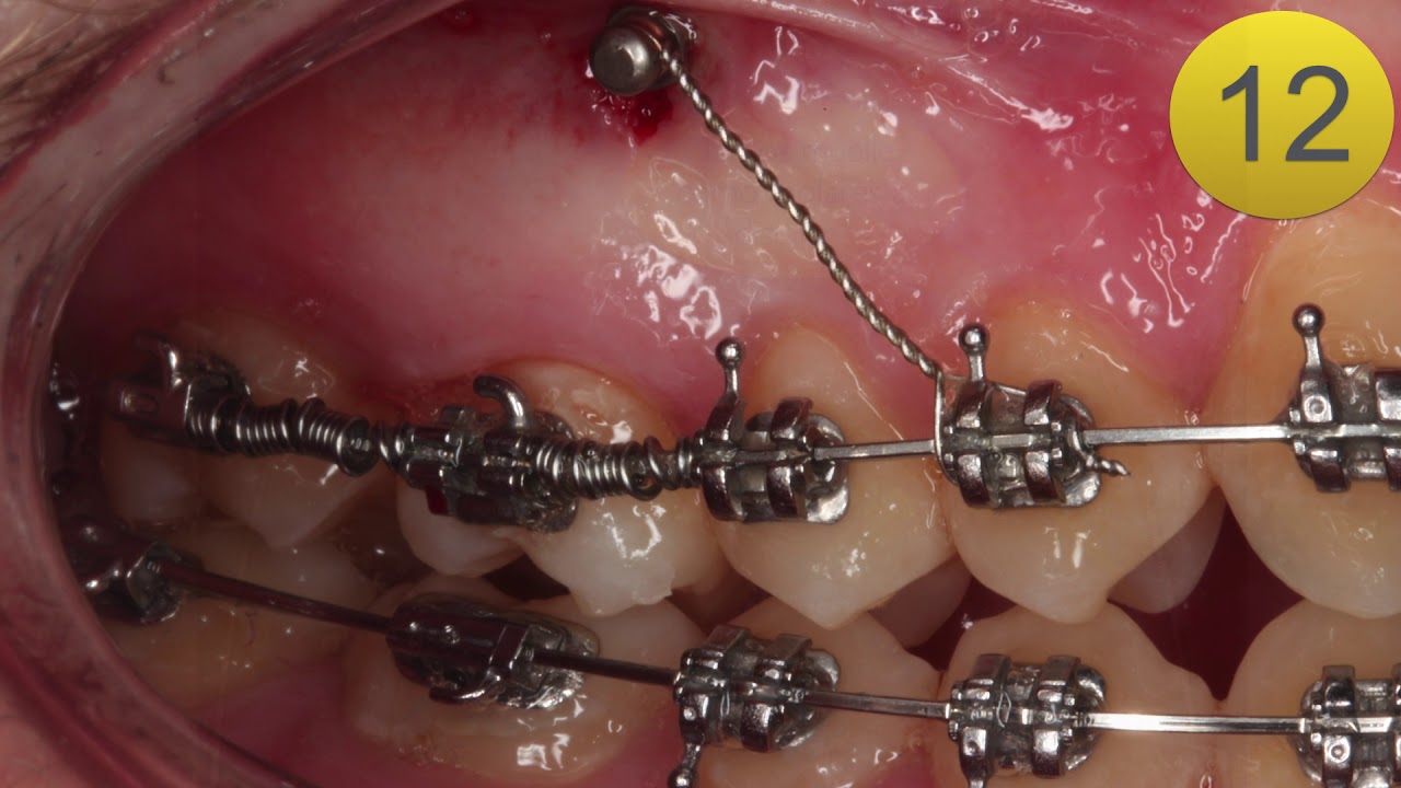 Técnica Distalamiento Molar Minitornillo - YouTube