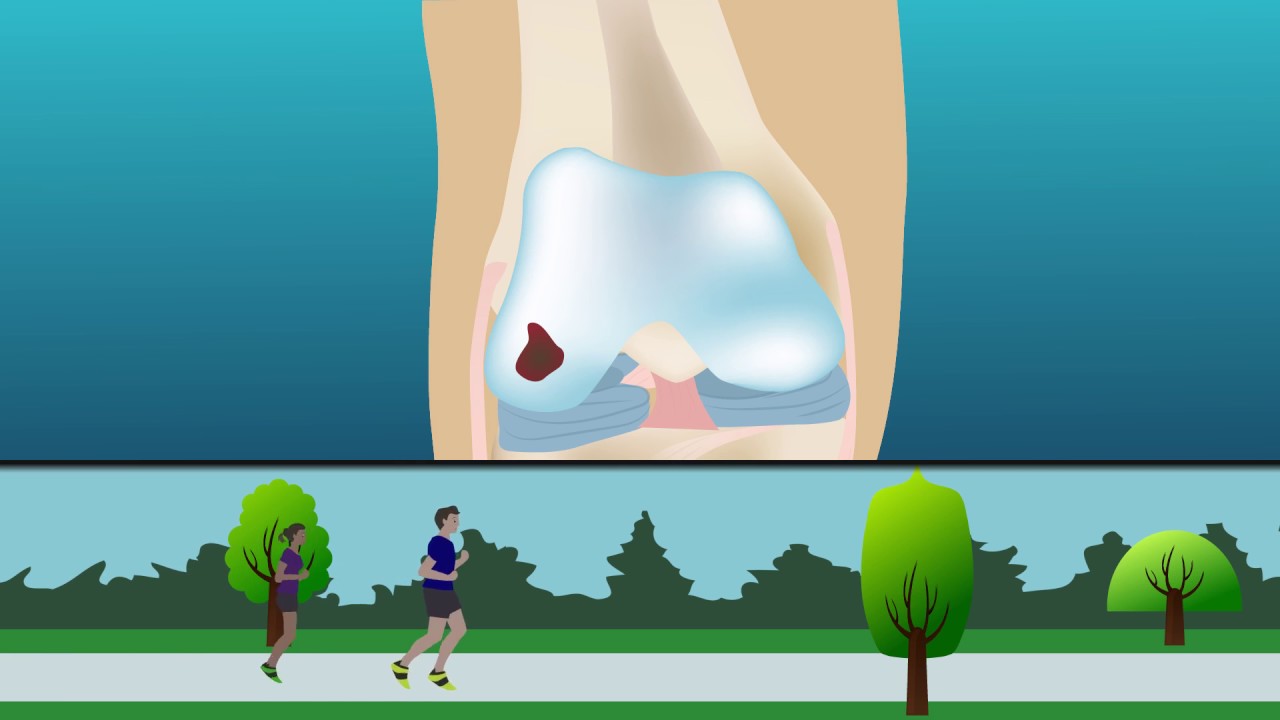 Using osteochondral allograft transplantation to treat articular ...