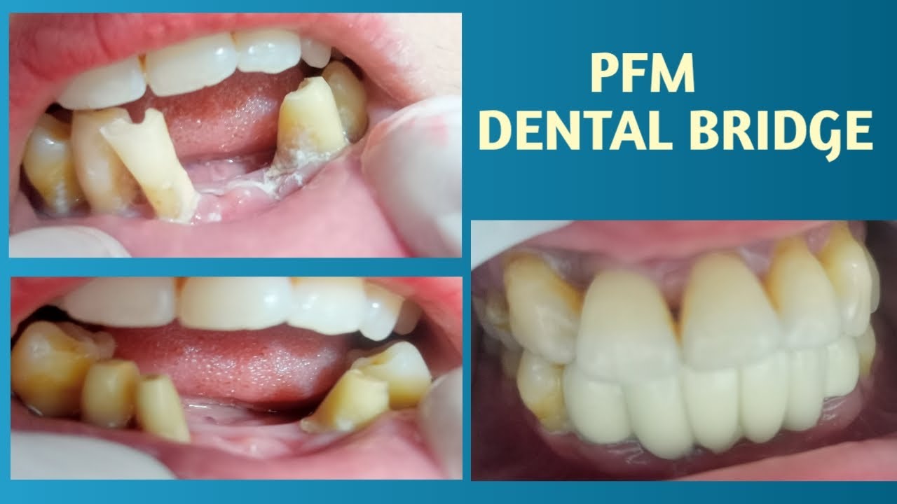Lower 6 unit Dental bridge - YouTube