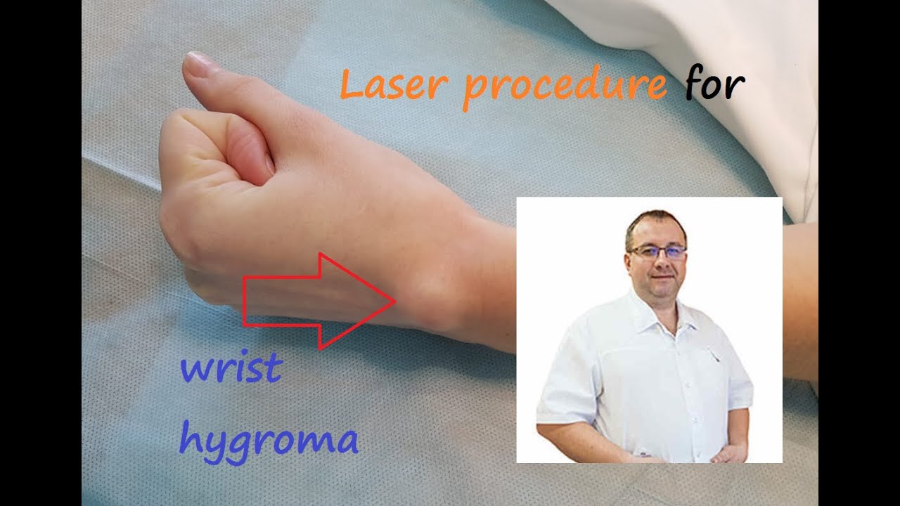 Laser surgery for wrist hygroma (Ganglion cyst) - minimally invasive ...