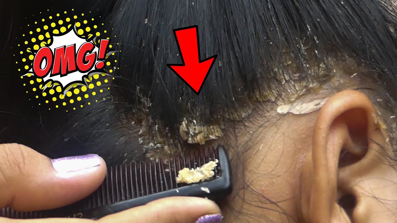 Real Dandruff Scratching Scalp On Head Flakes Using Combing 8652 Youtube