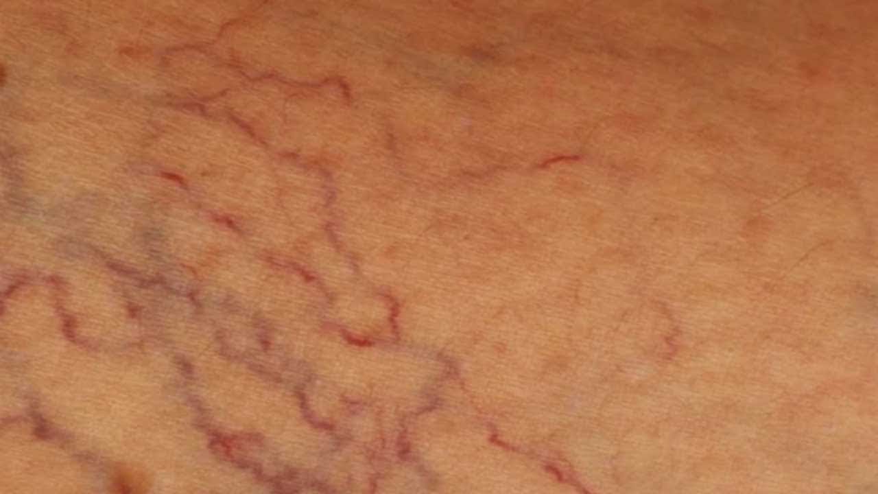 Comment se débarrasser des varices et varicosités naturellement - YouTube