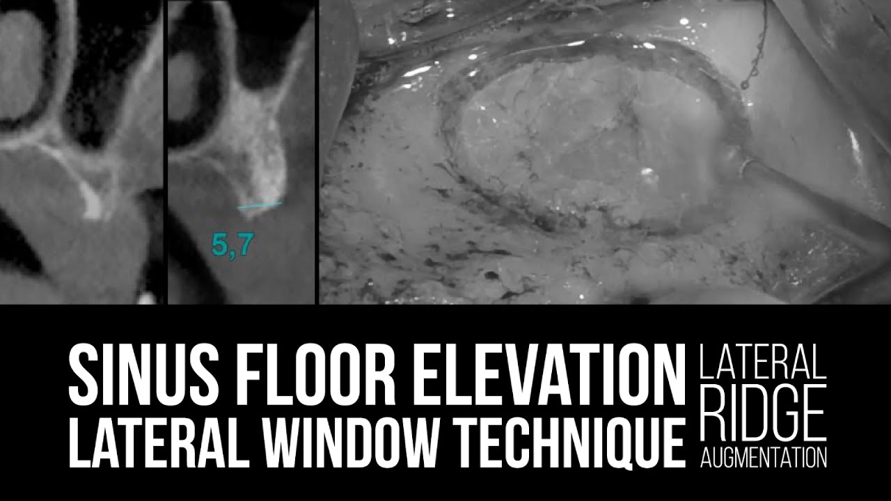 Maxillary Sinus Lift with Lateral Window Technique - simultaneously ...