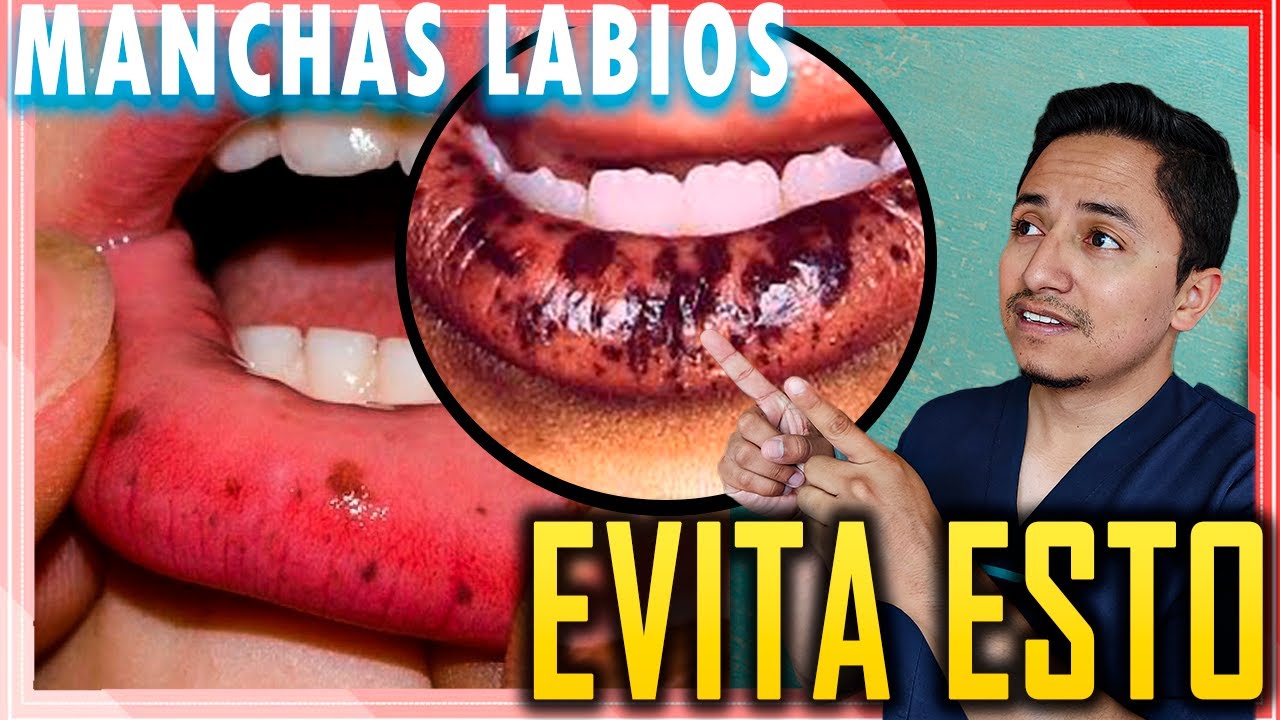 La Cura Mas EFECTIVA para las Manchas en los Labios (EVITA que ...